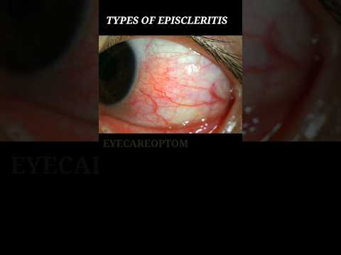 Different types of episcleritis @eyecareoptom5506 #short #shorts #viral #trending #episcleritis