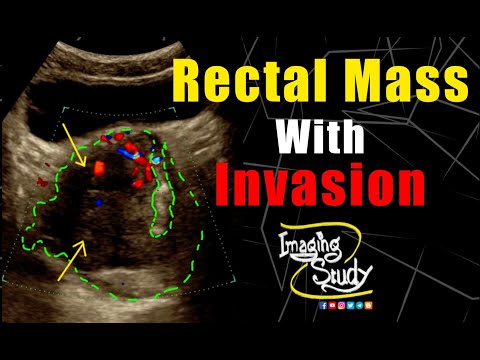 Rectal Malignant Mass with Invasion || Ultrasound || Doppler || Case 284