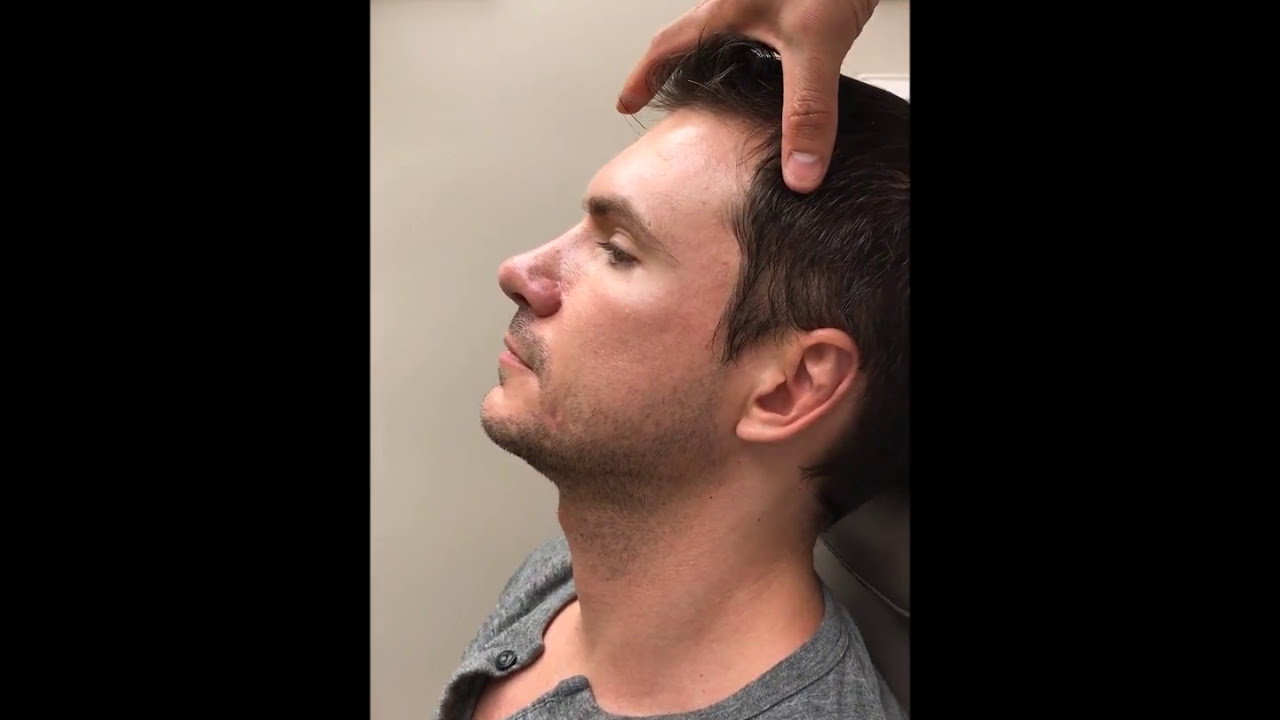 Raising the Low Nasal Bridge with Temporalis Fascia | Anthony Bared, MD, FACS Miami, FL