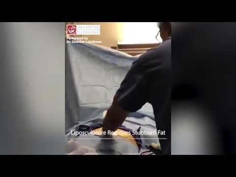 Liposuction Procedure - Pasadena Surgeons - Dr Shankar Lakshman