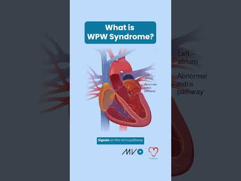Wolff-Parkinson-White (WPW) Syndrome ⚡️💓