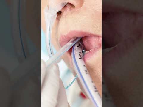 Suction Catheter