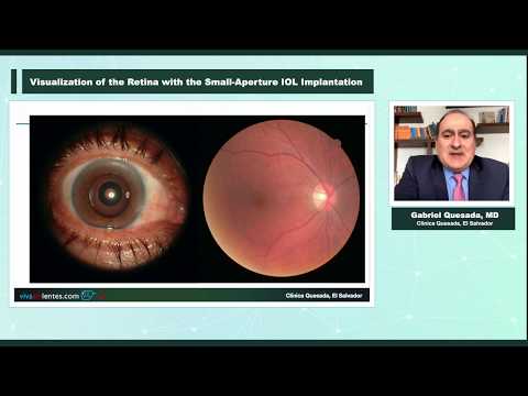 Visualization of the Retina with the Small-Aperture IOL Implantation | EYE NEWS TV