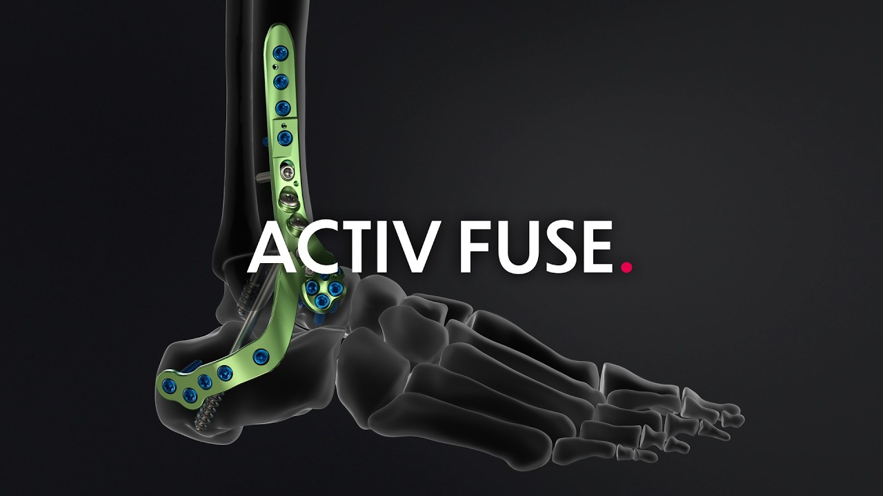 Activ Fuse - Ankle fusion