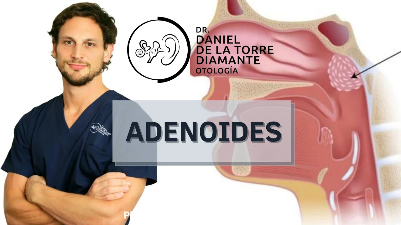 ¿Cómo se sienten las adenoides infectadas? – VALETRY
