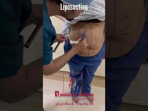 liposuction | body contouring | Dr Mudassir Mahboob-Plastic Surgeon