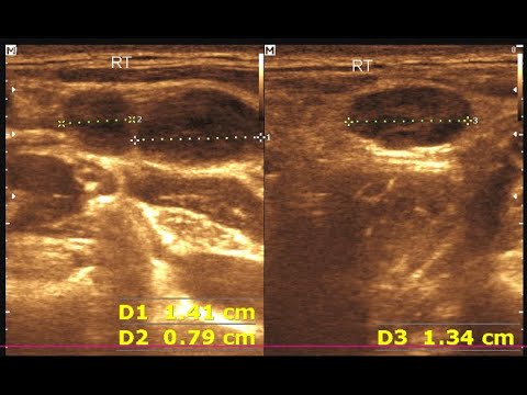 Enlarged Lymph Nodes in Child: Ultrasound Findings in Neck, Axilla, and Inguinal Region