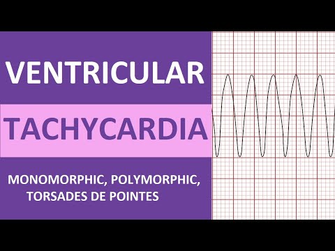 Polymorphic Ventricular Tachycardia Strip