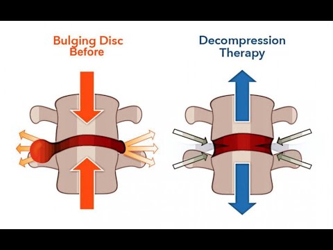 Decompression CPT codes - simplify medical coding