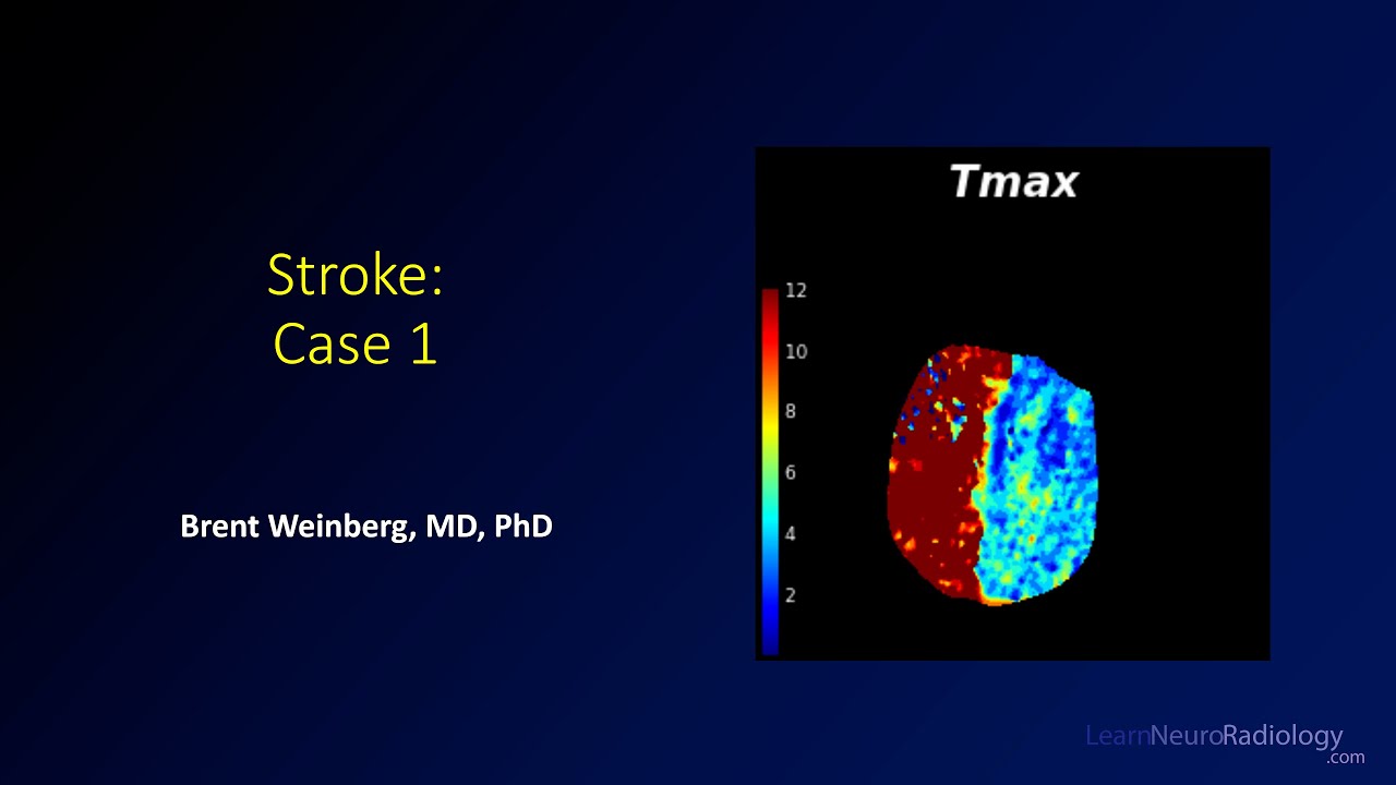 Stroke Imaging – Case 1