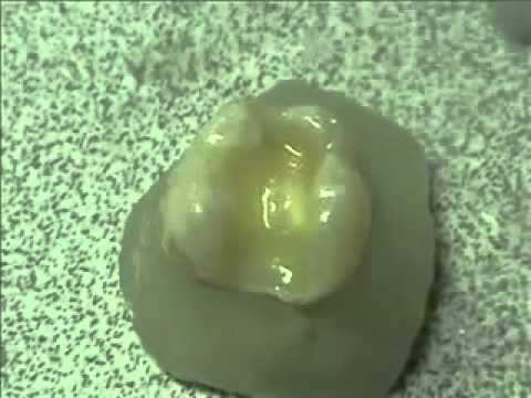 Sure Dental Surpass Instructions - YouTube.flv