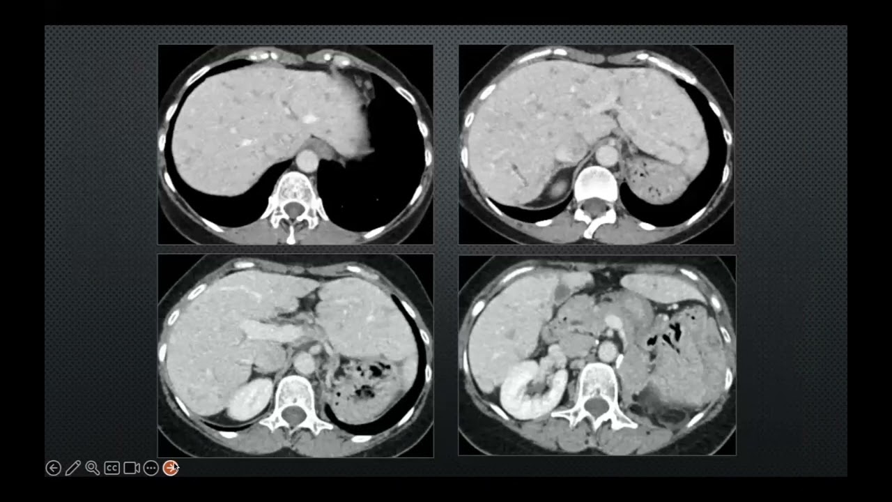 Read with the Experts: Hepatobiliary.  Example Case - May 2025