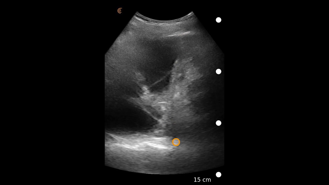 Image Interpretation: Pleural Effusion