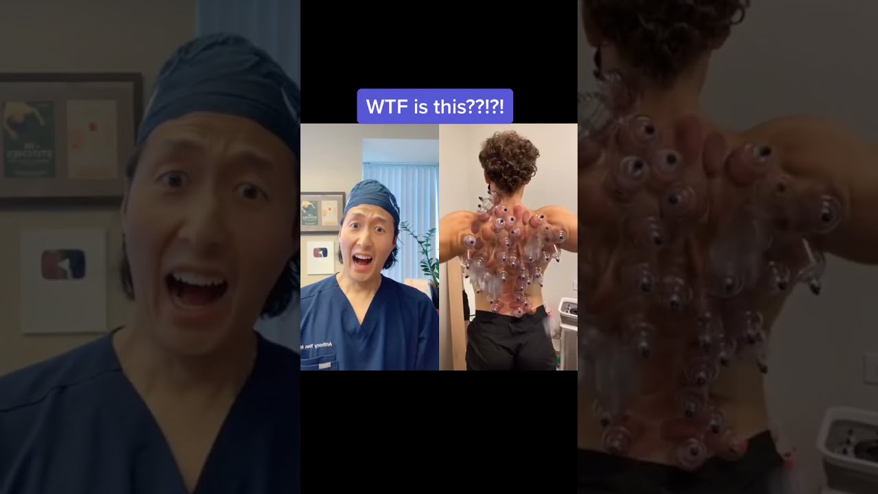 Extreme Cupping Therapy! #shorts #cupping