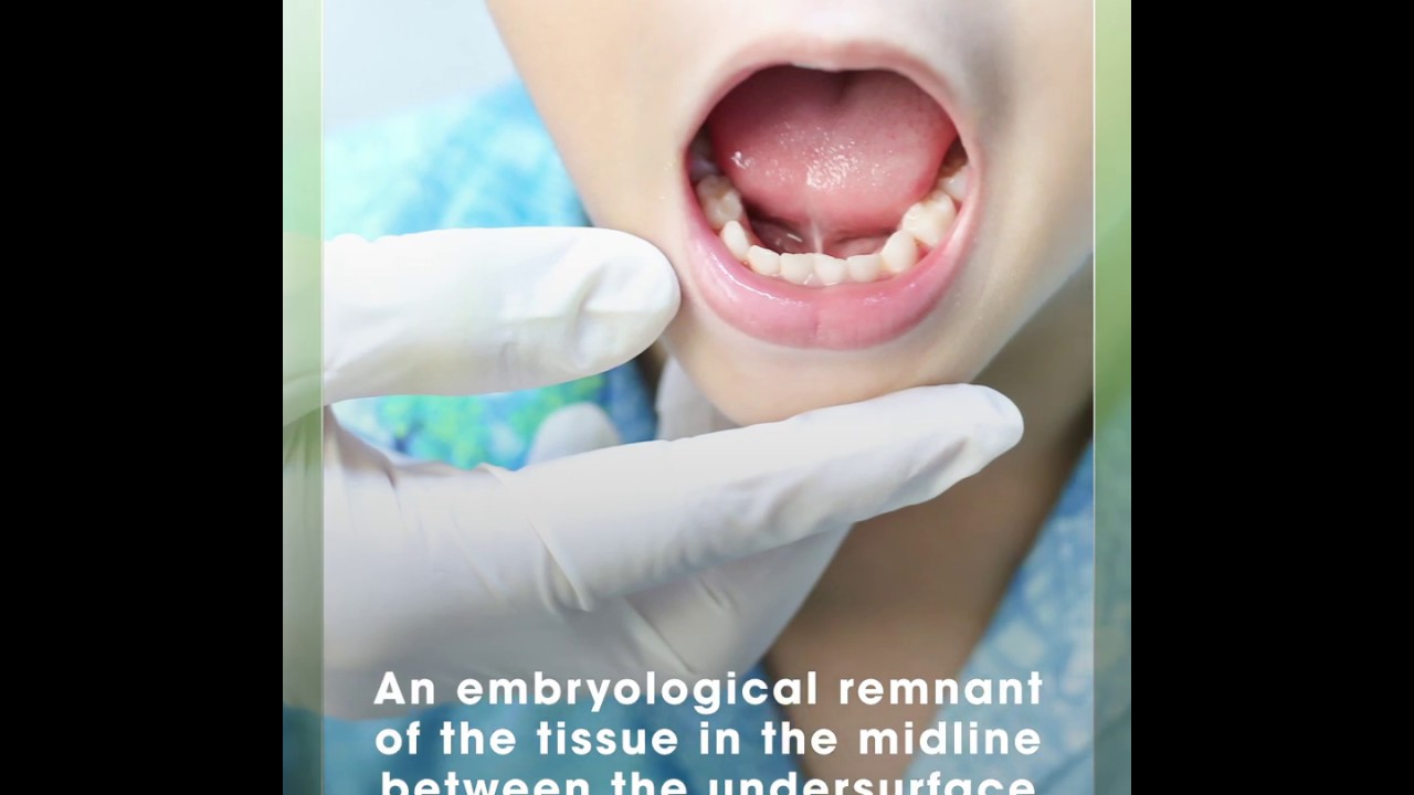 Tongue-tie Treatments in Pediatric Dentistry | Laser Dentistry in Dubai