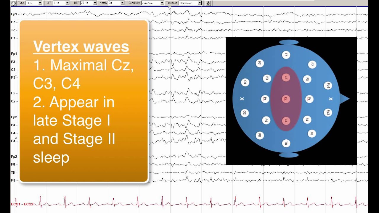 7  EEG in Normal Sleep