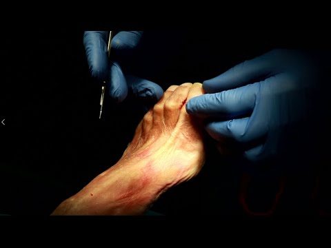 FuseRight Hammer Toe Surgery Utilizing The K-Wire Drill