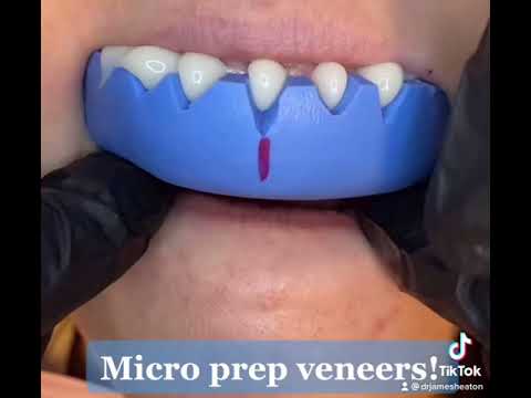 Temporary Veneers