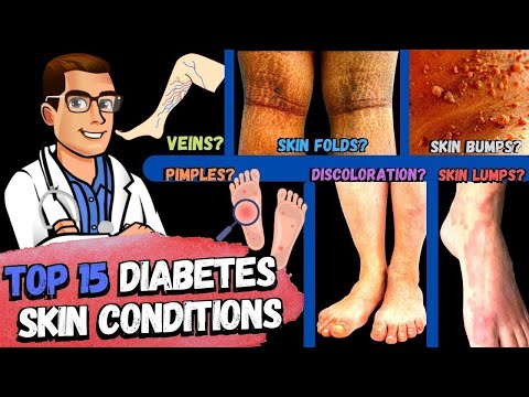 TOP 15 Diabetes Skin Signs & Symptoms [Type 2 & 1 Diabetes Mellitus]