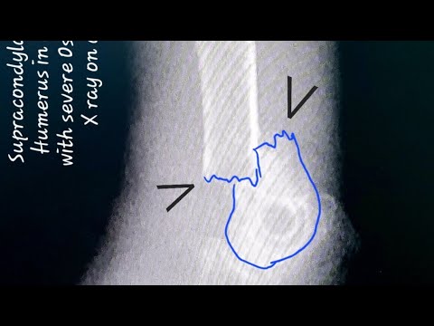 Supracondylar fracture Humerus | Closed reduction | Fractures in Elderly people | Adamya Hosp videos