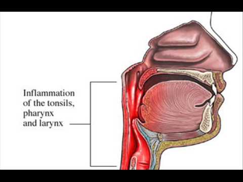 COMMON COLD 3 , CHRONIC CORYZA , HEALTH EDUCATION , INFECTION CONTROL (ICSP) , URDU / HINDI