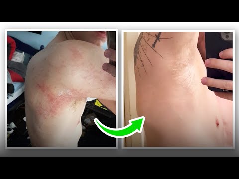 Akkermansia - Strengthen Your Gut Lining