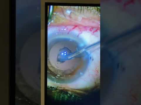 Latest Technology in Cataract Surgery