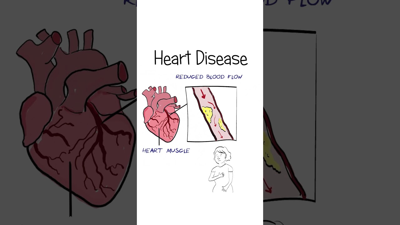 Heart Attacks EXPLAINED #healthsketch #shorts