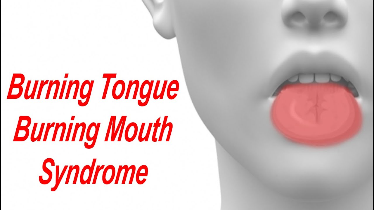 Burning Tongue and Burning Mouth Syndrome: Causes and Treatment