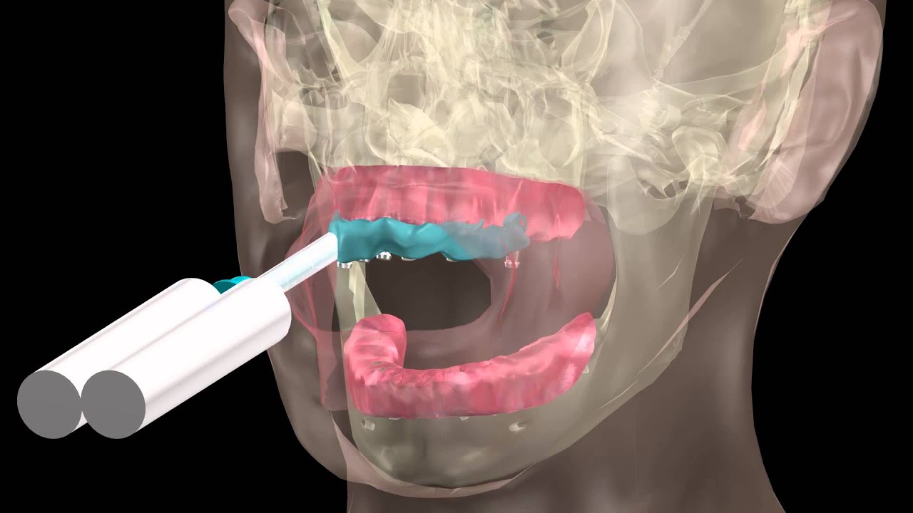 Non-Engaging Impression Coping Technique