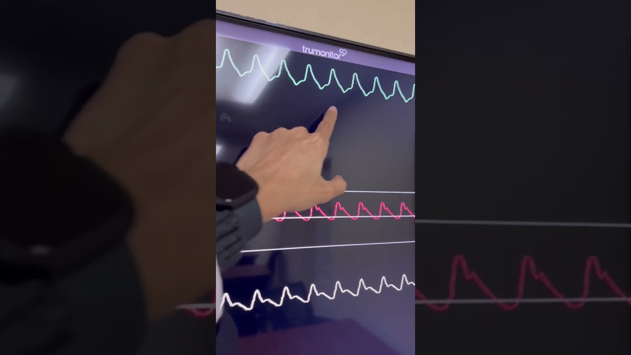 How to Identify Cardiac Arrest Rhythms on an ECG: Part 1: Ventricular Tachycardia
