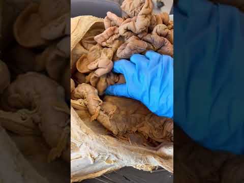 What's LURKING Behind Your Intestines...