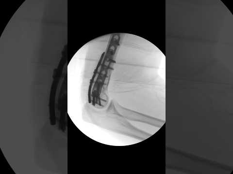 Distal Humerus Fracture #ortho #trauma #science #education #humerus #fracture