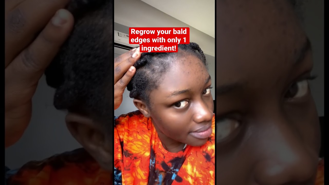 This is all you need! Regrow your bald edges|