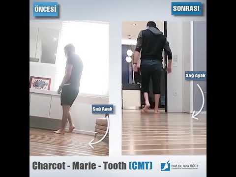 Charcot - Marie - Tooth (CMT) | Prof. Dr. Tahir Öğüt