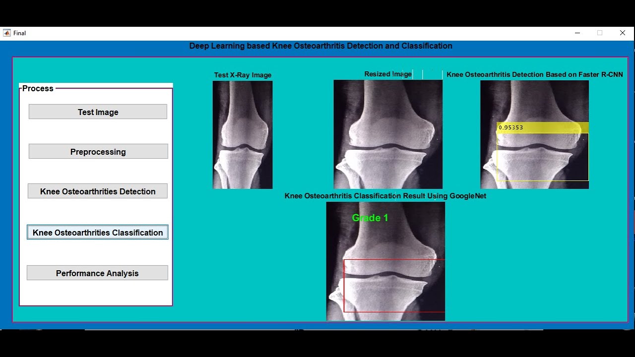 Knee Osteoarthritis Detection and Classification Using X-Rays | Deep Learning | MATLAB IEEE Project