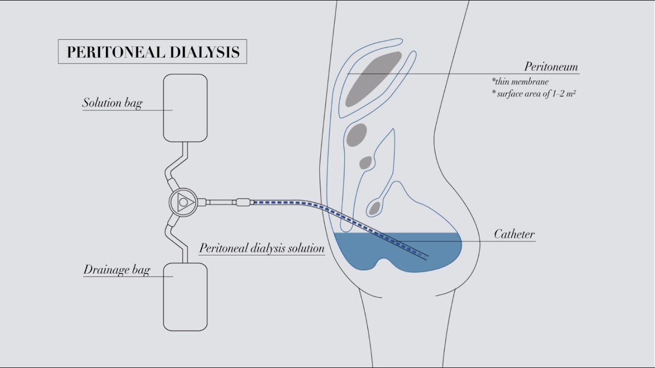 Understanding peritoneal dialysis