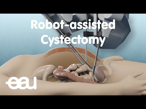 Robot-Assisted Cystectomy