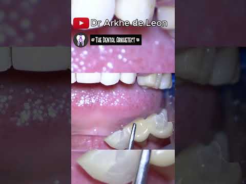 DENTAL CROWNS! Patient's Request to Make Her Teeth Uniform (PART 1) #4k #dentist