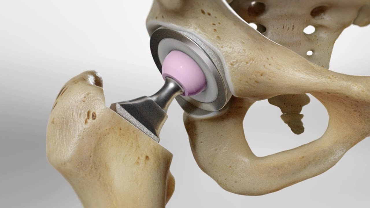 Total Hip Replacement (3D Animation)