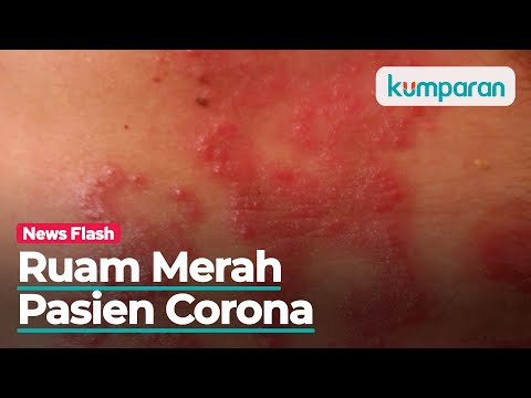 Ruam Merah Pada Pasien Positif COVID-19, Ini Penjelasan Dokter ...