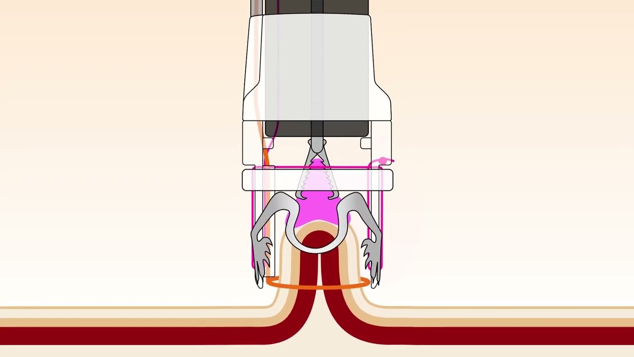 FTRD® System | Procedural steps for patient & physician