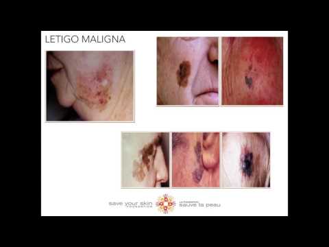 Educational Video Series: What is Melanoma?