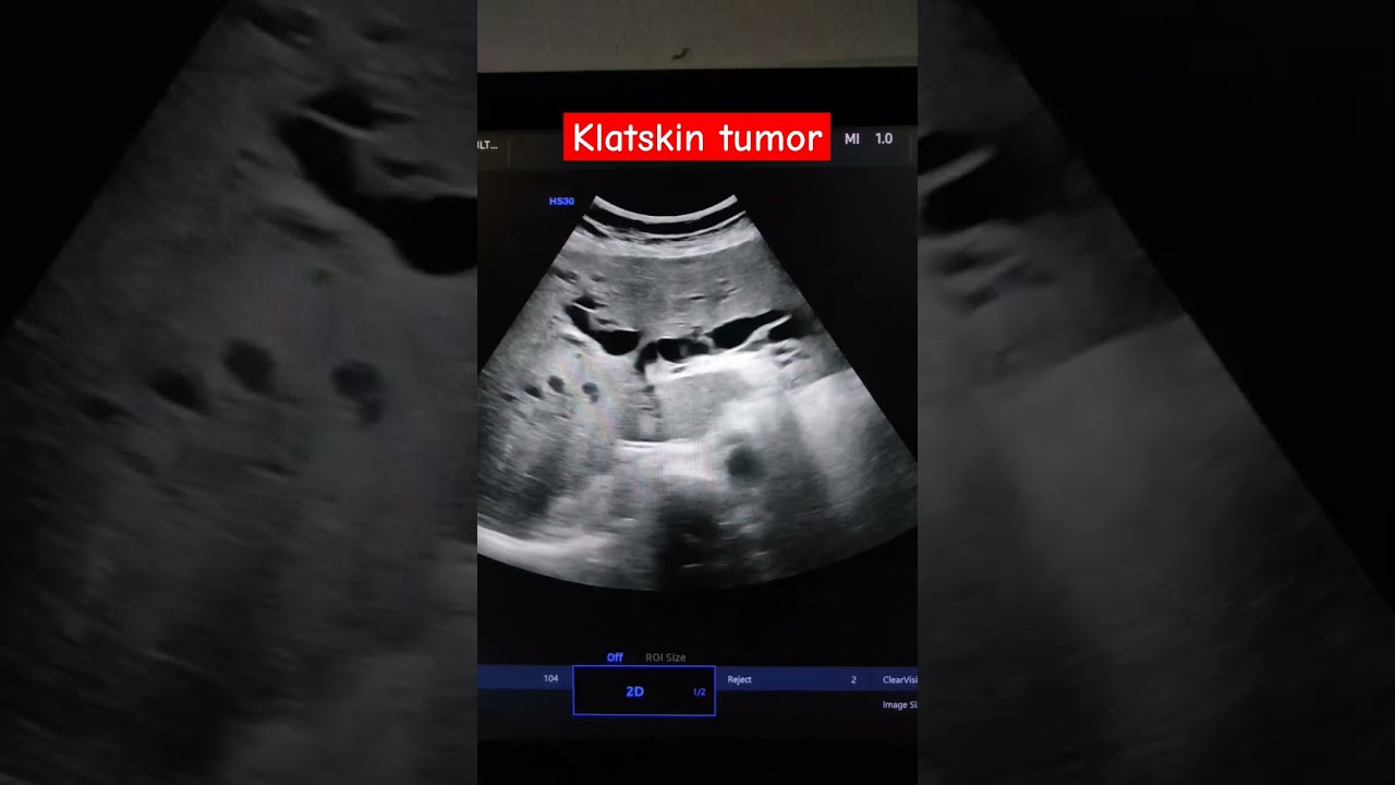 Klatskin tumor (hilar cholangiocarcinoma)