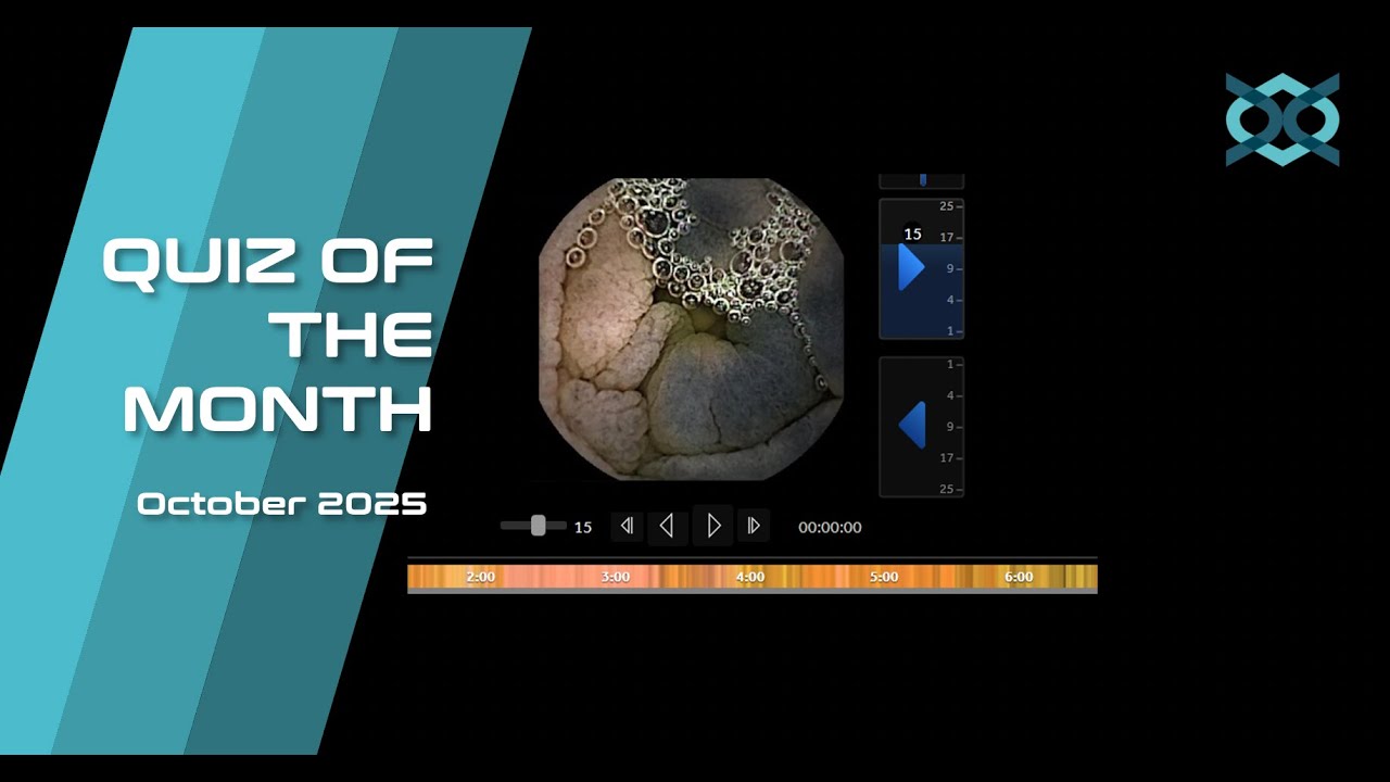 Black-coloured finding during capsule endoscopy