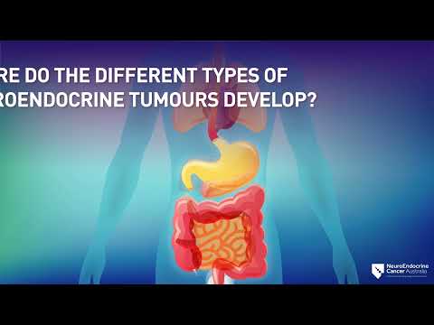 Symptoms Types and Diagnosis of Neuroendocrine Tumours (NETs)