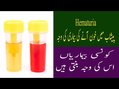 Hematuria Blood In Urine 8 Causes In Urdu Peshab Mein Khoon Aane Ki Wajah