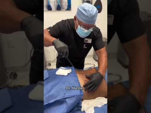 Flanks Gone With One Treatment!