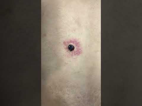 Skin Tag Removal by Laser 💥 | Say Goodbye to Annoying Skin Tags | Skinaa Clinic #viral
