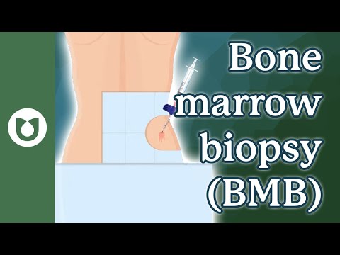 Myeloma Basics Part 2 (2019): Why are bone marrow biopsies (BMB) used ...